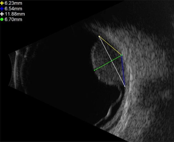 Ultrasound of the eye - Retina Center