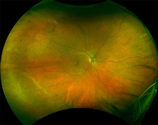 Fundus photo - Retina Center