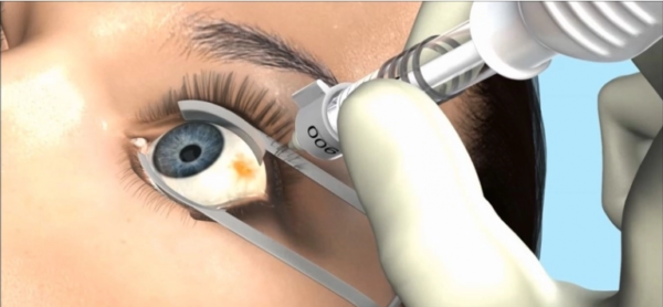 Intraocular injection - Retina Center