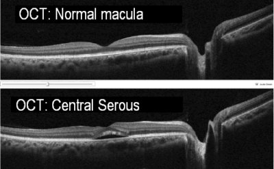 Central Serous Chorioretinopathy - Retina Center