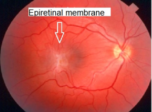 Epiretinal - Epimacular Membrane - Retina Center