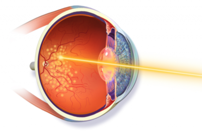What is Argon Laser? - Retina Center