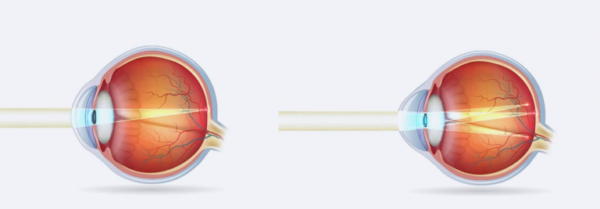 Astigmatism - Retina Center