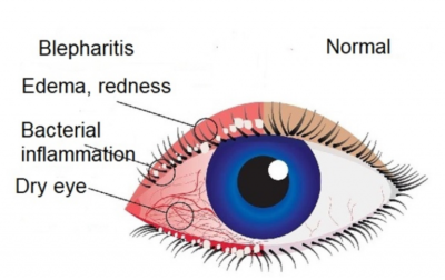 Chronic Blepharitis - Retina Center