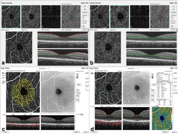 OCT –Αngiography (OCT-Angio) - Retina Center