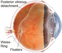 Posterior Vitreous Detachment - Retina Center